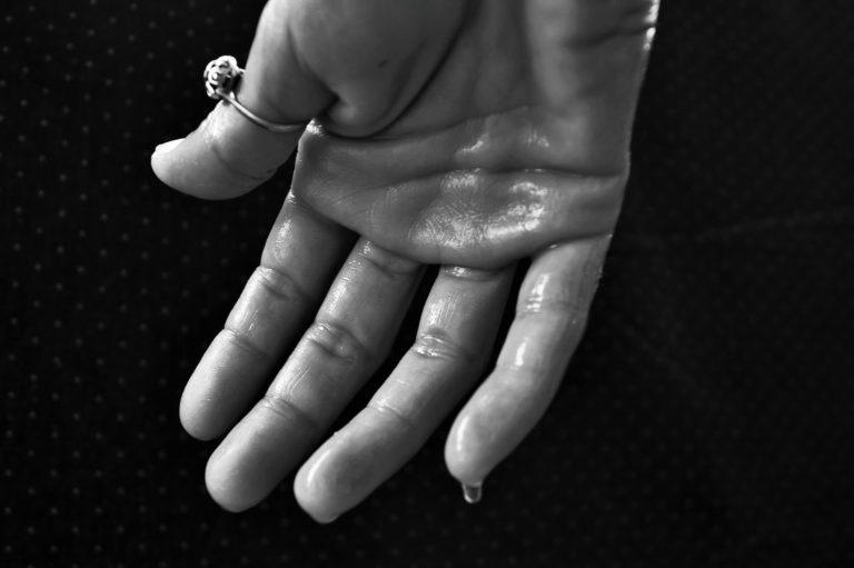 What Causes Clammy Hands? 7 Reasons & How To Stop It